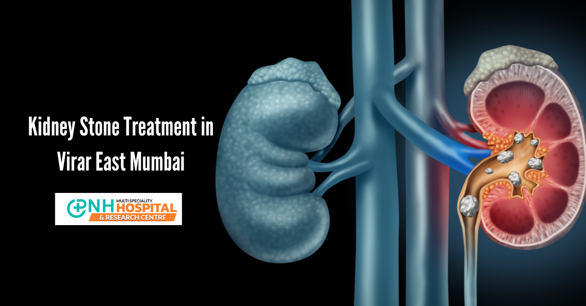 Kidney Stone Treatment in Virar East Mumbai | PNH Hospital, Mumbai